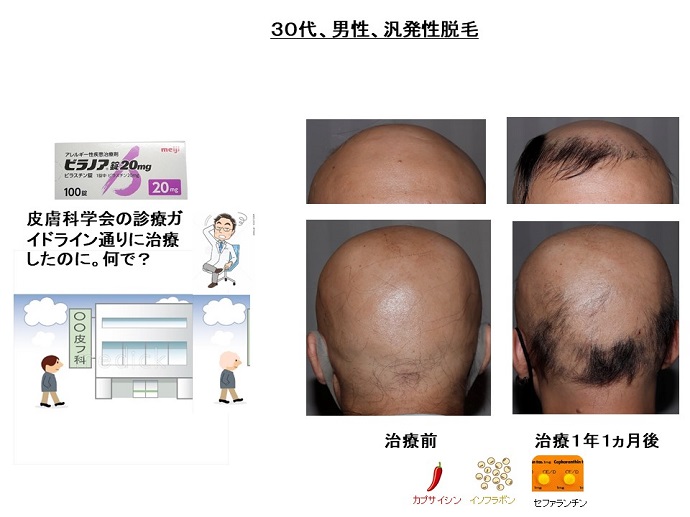 皮膚科治療（ビラノア）で汎発性脱毛になった患者様で改善！ 患者様からの声・メディア掲載・クリニックからのお知らせ 名古屋kクリニック